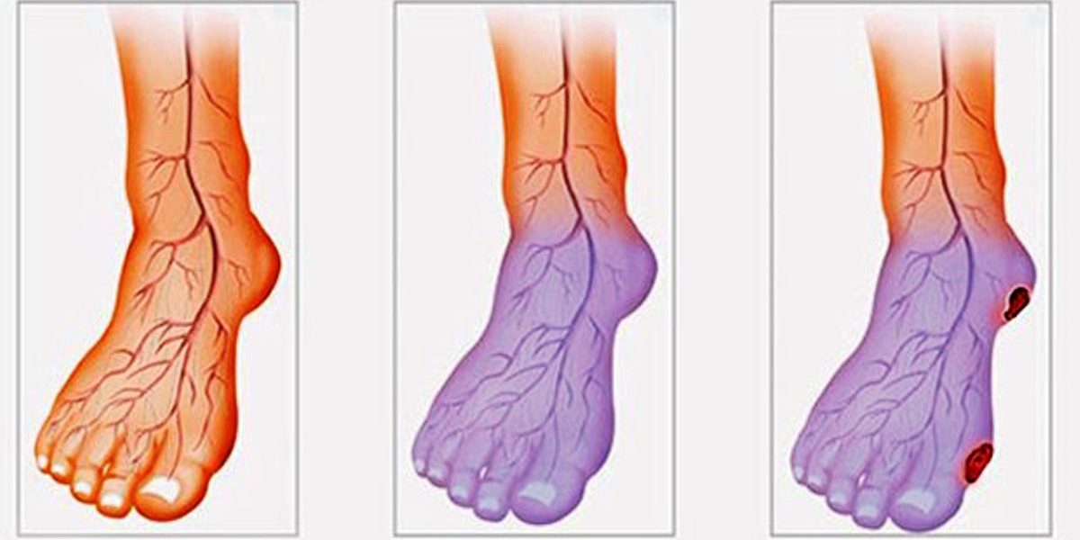 Poor Blood Circulation, Cold Hands & Legs? Here Is How to Solve this