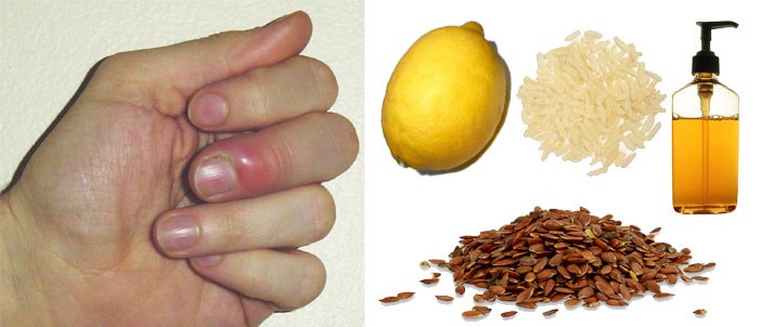 5 Effective & Easy Ways to Treat Finger & Toe Whitlow