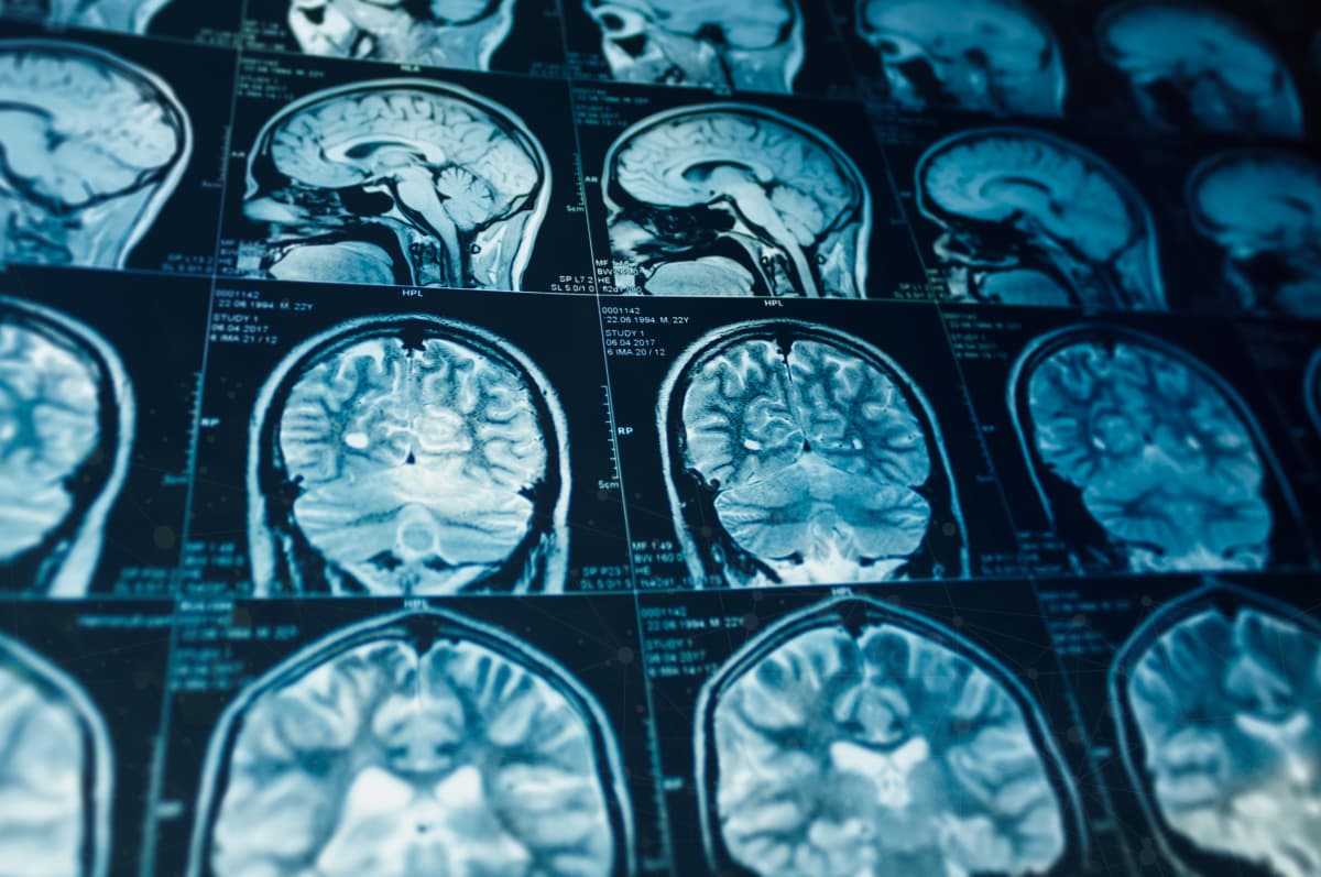 MRI Scans Cause Formation of Harmful Materials in the Body, New Study ...